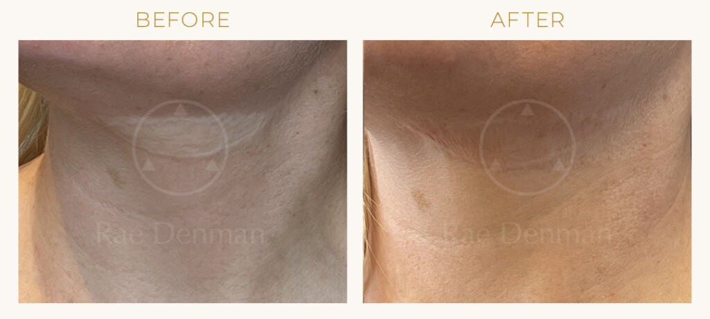 Medical Tattooing for Scarring | Scar Medical Tattooing | TLSC