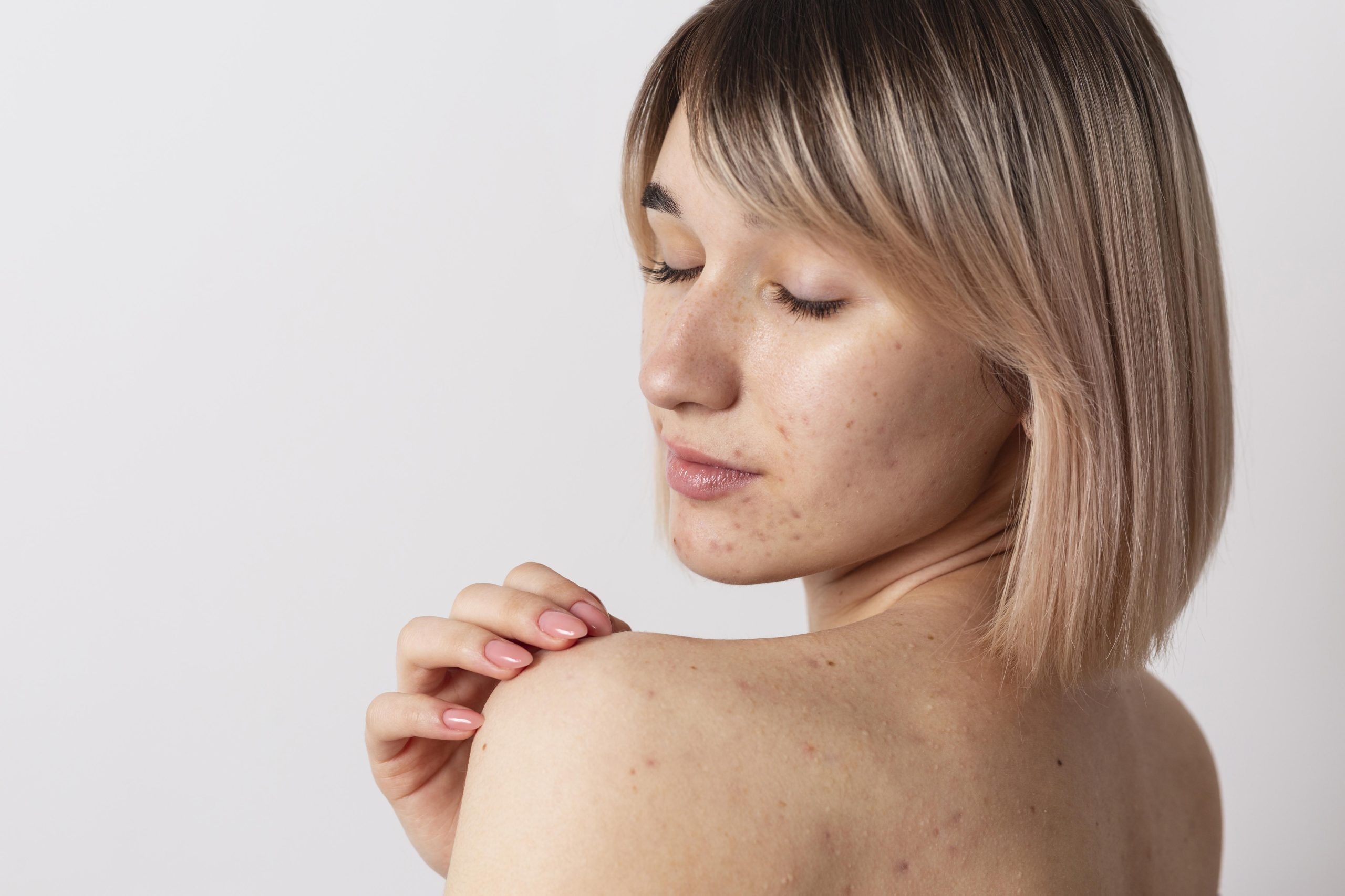 The Complete Guide to Laser Acne Scar Removal: What You Need to Know ...